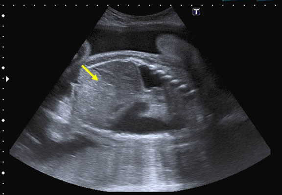 Pleural Effusion Fetal Ultrasound