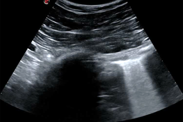 Case of the Month September – Bulging of the right flank of the abdomen ...