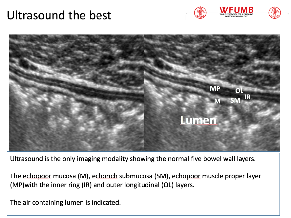 Ultrasound the Best #09: Ultrasound is the only imaging modality ...