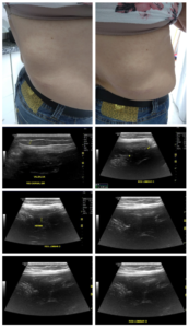Case of the Month September 2020- Bulging of the right flank of the ...