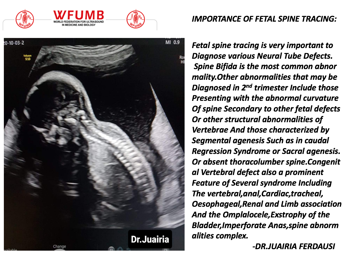 Ultrasound the Best #18: Fetal Spine Tracing – WFUMB