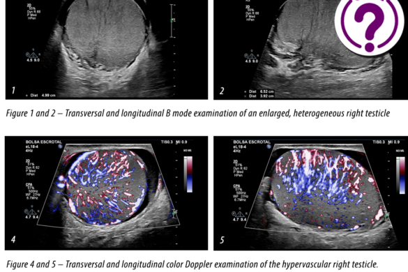 Case of the Month September – Bulging of the right flank of the abdomen ...