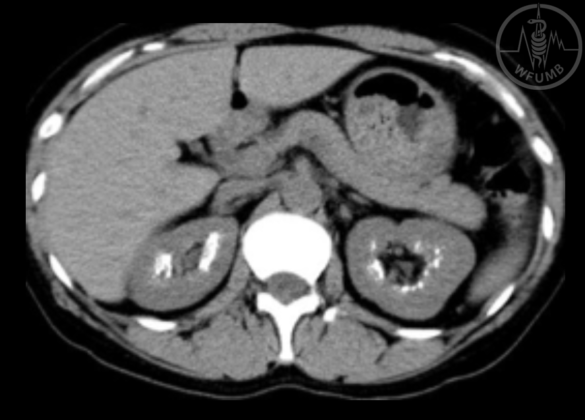 Ultrasound of the Kidneys and Adrenal glands – Chapter 17 Media Library ...