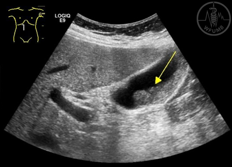 Gallbladder and Bile Duct System – Sonopathology – Chapter 14 Media ...
