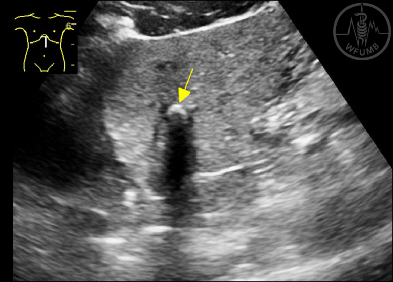 Gallbladder and Bile Duct System – Sonopathology – Chapter 14 Media ...