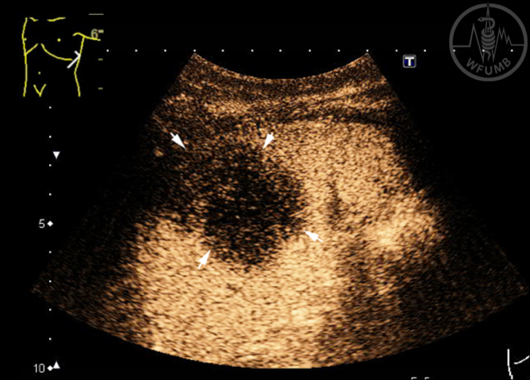 Spleen and Lymph Nodes – Chapter 16 Media Library – WFUMB
