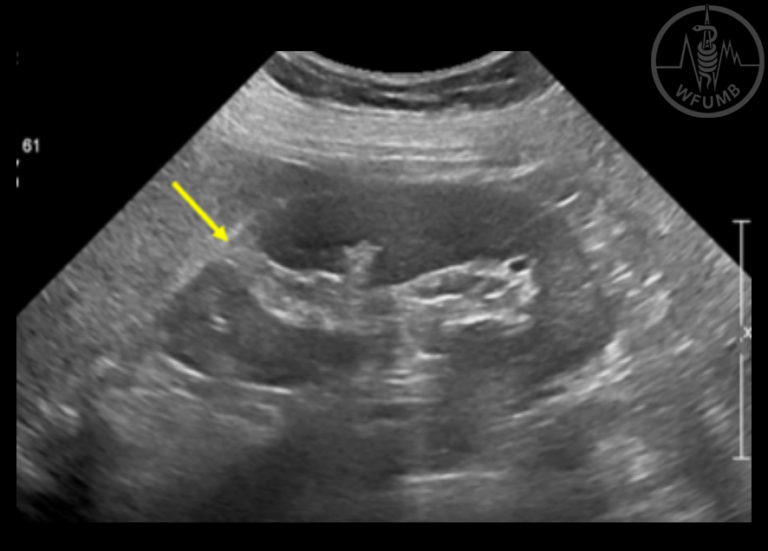 Ultrasound of the Kidneys and Adrenal glands – Chapter 17 Media Library ...