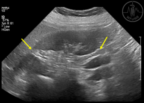 Ultrasound of the Kidneys and Adrenal glands – Chapter 17 Media Library ...
