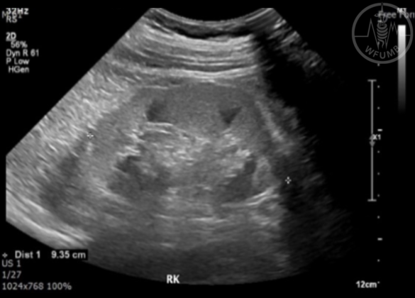 Ultrasound of the Kidneys and Adrenal glands – Chapter 17 Media Library ...