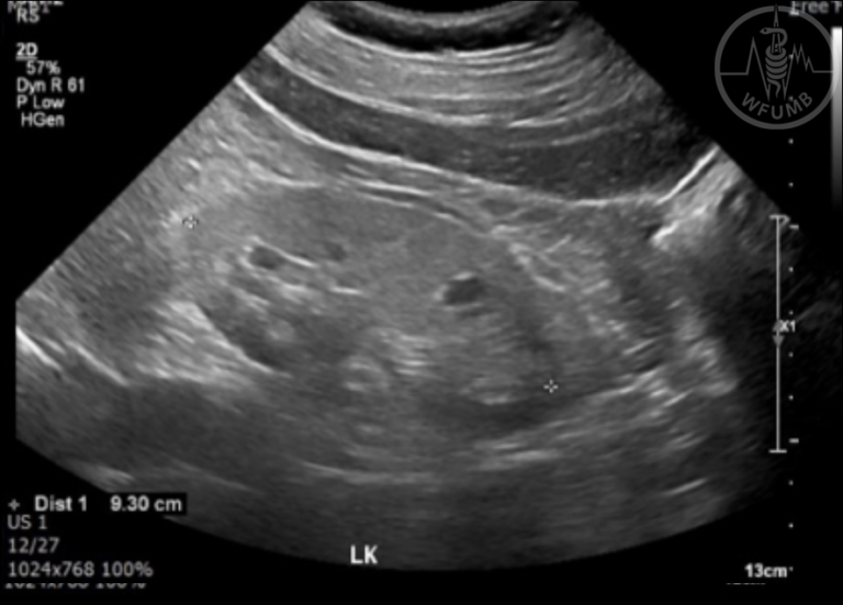 Ultrasound of the Kidneys and Adrenal glands – Chapter 17 Media Library ...