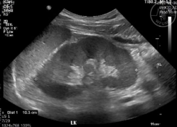 Ultrasound of the Kidneys and Adrenal glands – Chapter 17 Media Library ...