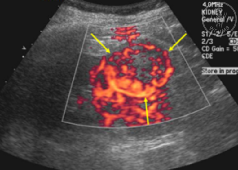 Ultrasound of the Kidneys and Adrenal glands – Chapter 17 Media Library ...