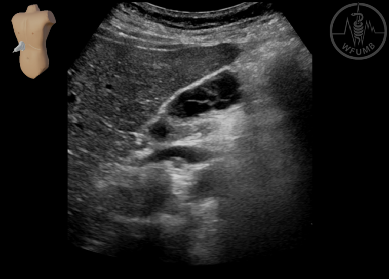 Examination of the Gallbladder and the Bile Duct System Chapter 7 Media ...