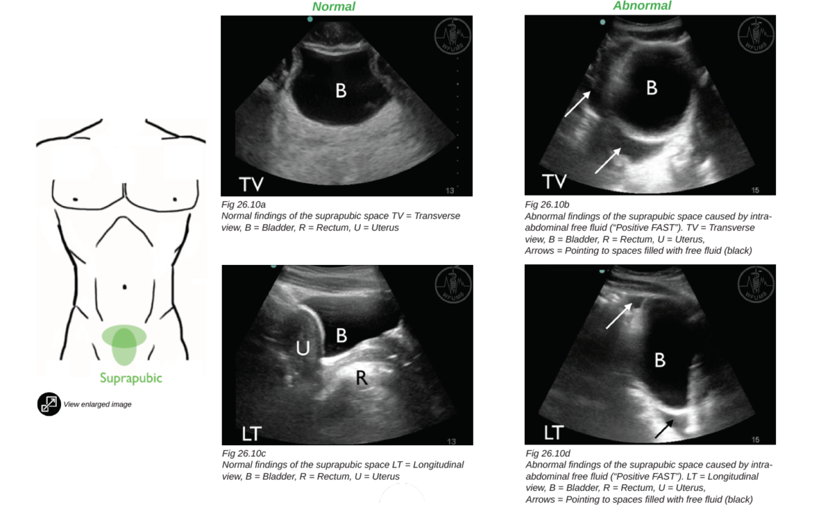 The E-FAST Exam – Chapter 26 Media Library – WFUMB