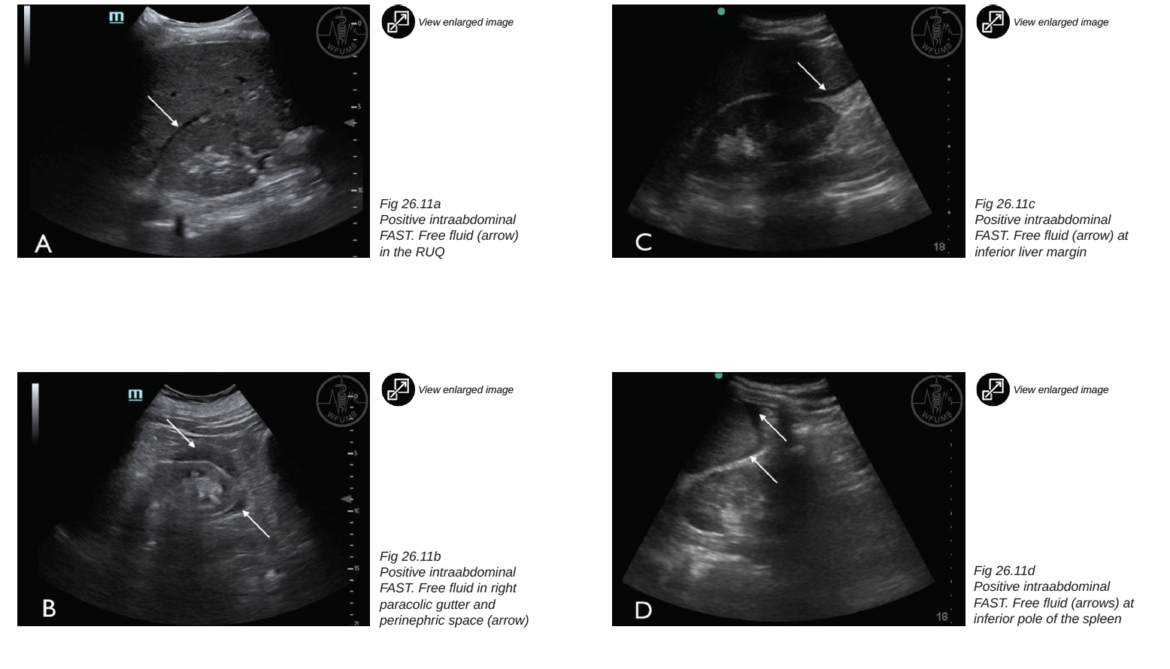 The E-FAST Exam – Chapter 26 Media Library – WFUMB