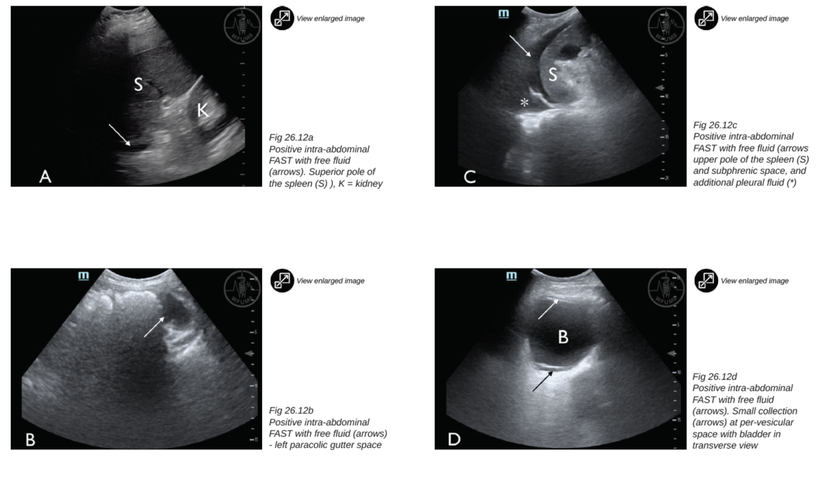 The E-FAST Exam – Chapter 26 Media Library – WFUMB