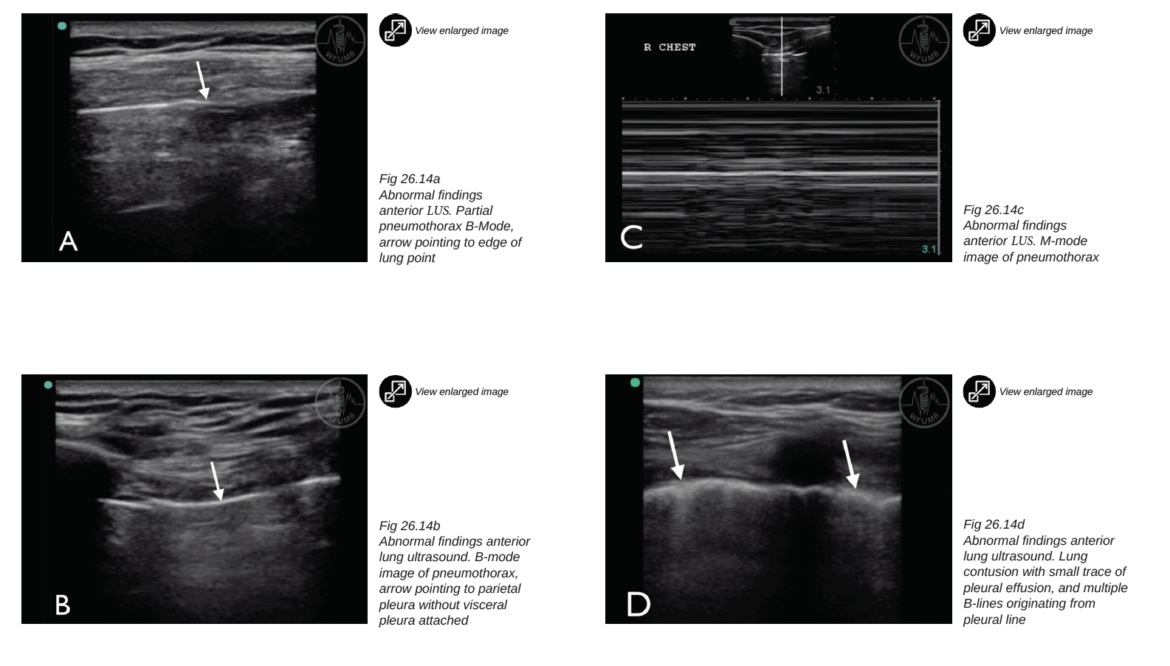 The E-FAST Exam – Chapter 26 Media Library – WFUMB