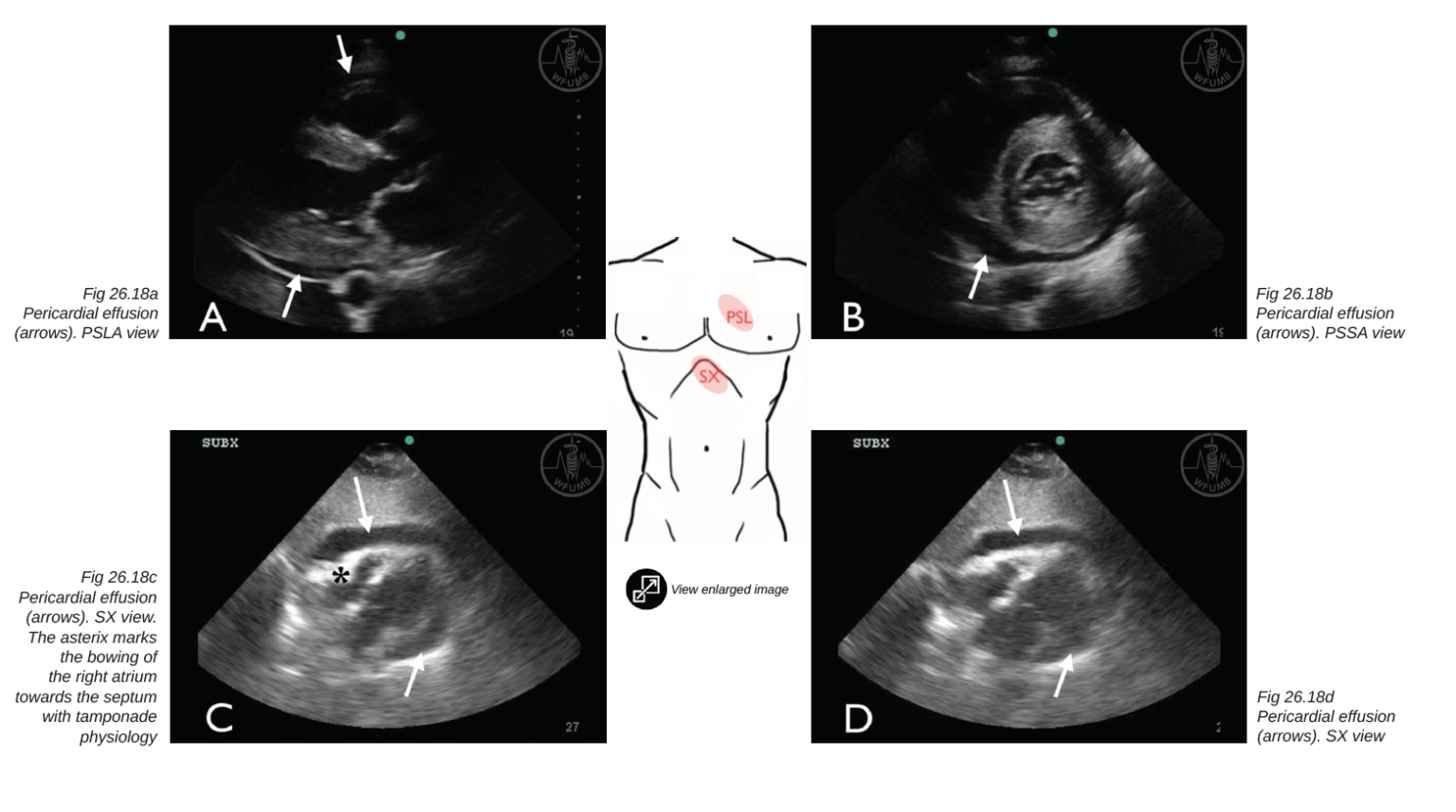 The E-FAST Exam – Chapter 26 Media Library – WFUMB