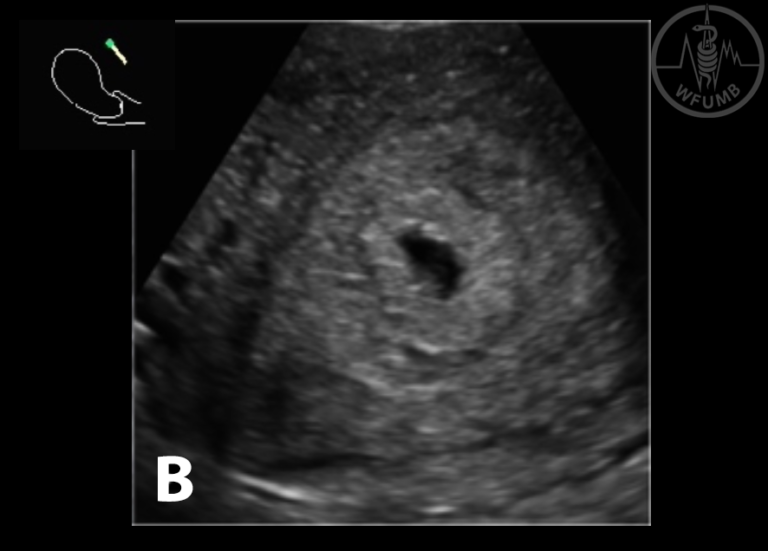 Basics of Ultrasound in Obstetrics – Chapter 20.1 Media Library – WFUMB