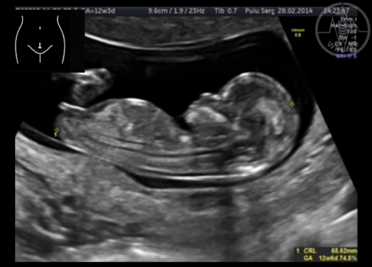 Basics of Ultrasound in Obstetrics – Chapter 20.1 Media Library – WFUMB