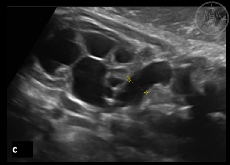 Basics of Ultrasound in Obstetrics – Chapter 20.1 Media Library – WFUMB