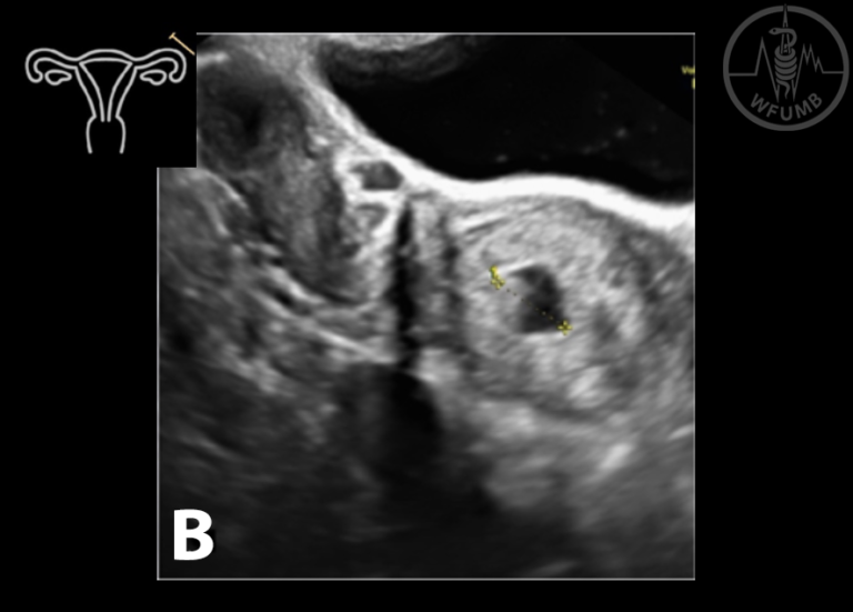 Basics of Ultrasound in Obstetrics – Chapter 20.1 Media Library – WFUMB