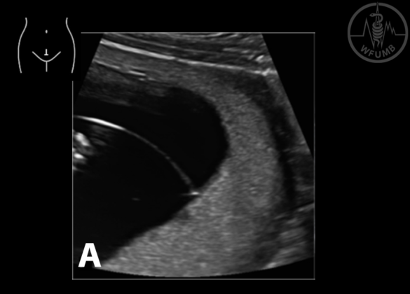 Basics of Ultrasound in Obstetrics – Chapter 20.1 Media Library – WFUMB