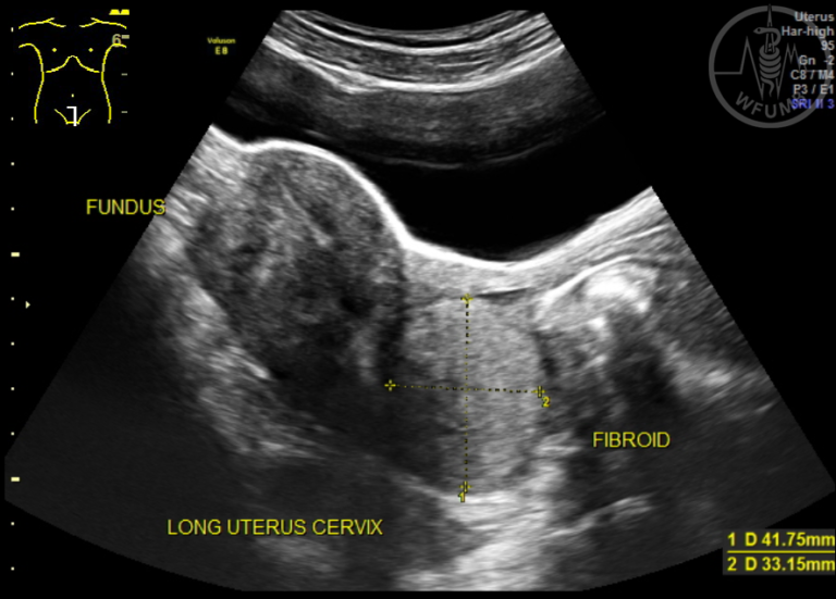 Basics in Gynecology – Chapter 20.2 Media Library – WFUMB