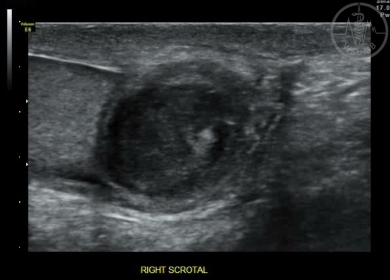 Basics in Urology – Chapter 21 Media Library – WFUMB