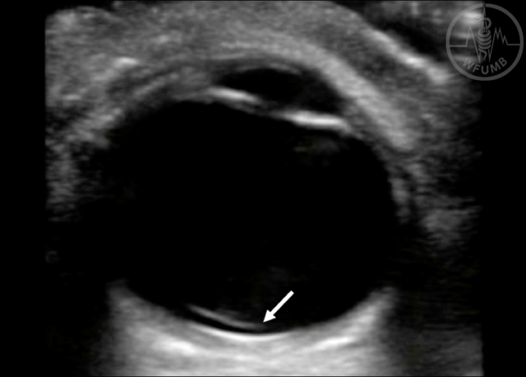Ocular Ultrasound – Chapter 25 Media Library – WFUMB