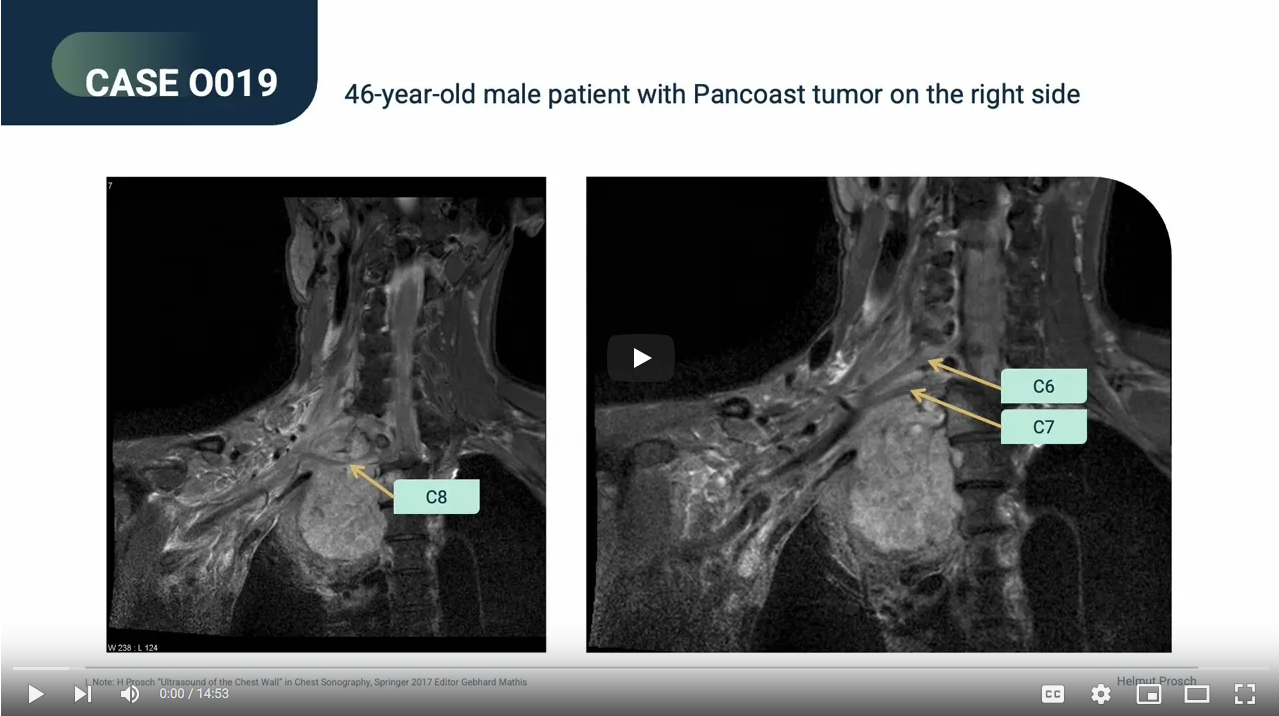 Percutaneous US in lung cancer staging ~ Helmut Prosch (Austria) – WFUMB